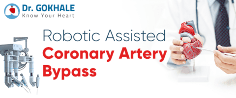 Robotic Assisted Coronary Artery Bypass | Dr. Gokhale