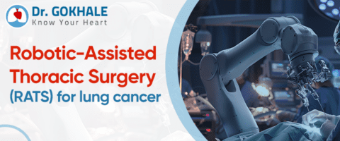 Robotic-Assisted Thoracic Surgery (RATS) for lung cancer